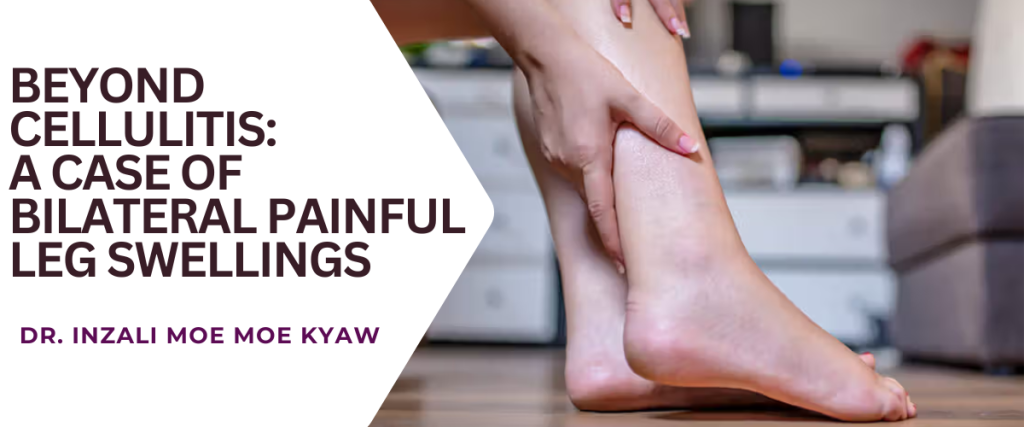 Beyond Cellulitis: A Case of Bilateral Painful Leg Swellings – MJCMP ...